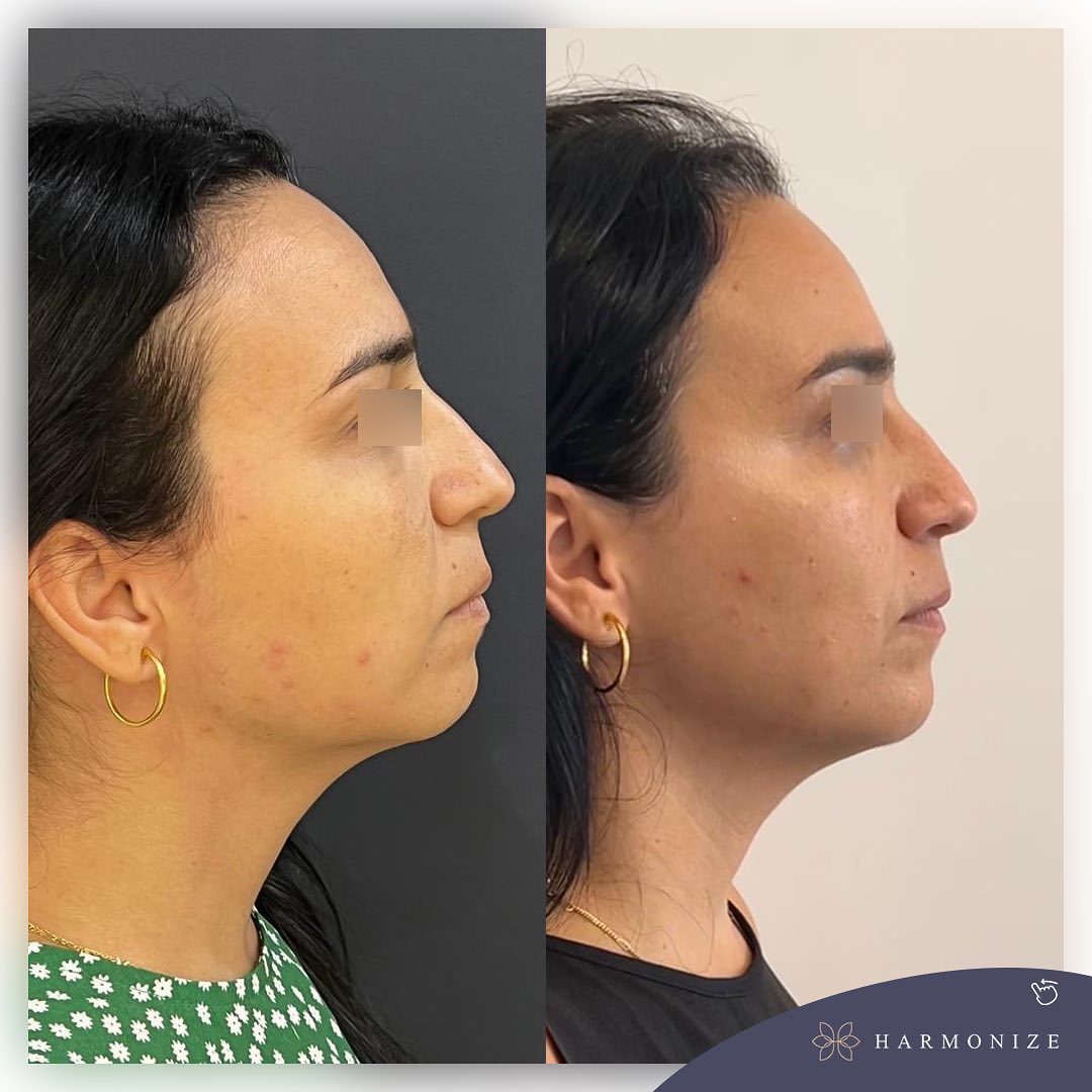 Preenchimento do Mento (Queixo) - Juliana Fontes - Agende sua avaliação